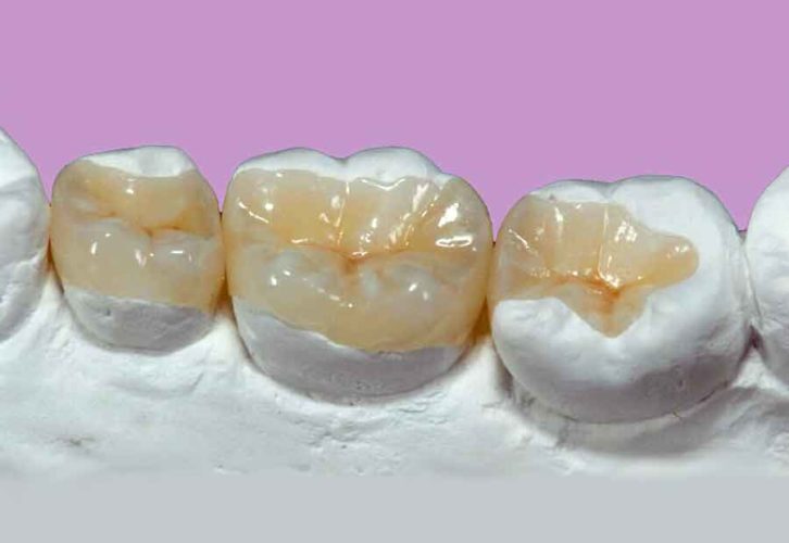 Porcelain Inlays & Onlays - Smile Creations